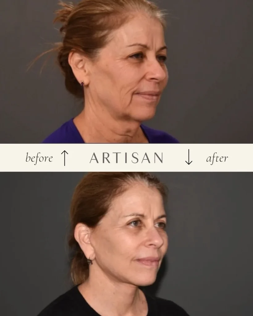 Deep Plane Facelift: Advanced Technique for Natural, Long-Lasting ...